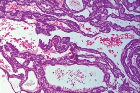 What Is Canalicular Adenoma Pathosomes