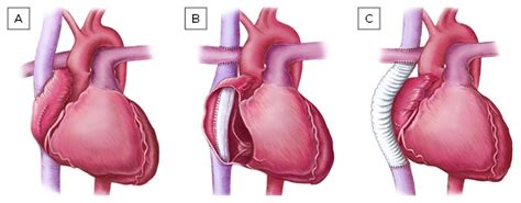 Editors Pick The Fontan Circulation European Medical Journal