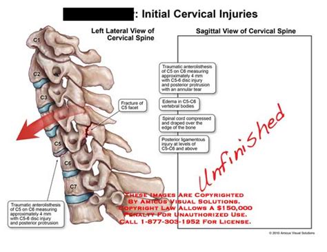 Initial Cervical Injuries