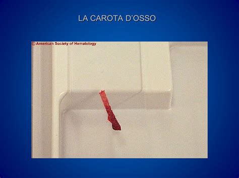 Mielogramma 4x 15x 100x Blasti 2 03 5 Promielociti 5 1 8 Ppt