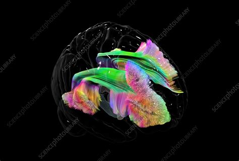 Arcuate Fasciculus Dti