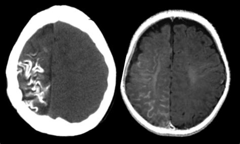 Sturge Weber Syndrome Stroke Manual
