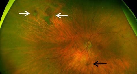 Optic Disc In Patients With Peripheral Retinal Tears Cia Dove