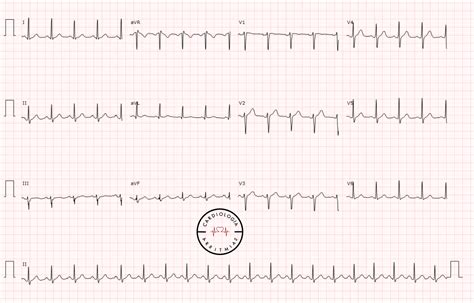 Taquicardia Ventricular Monomorfa Tvm 2025