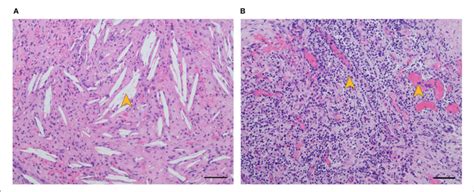 Hande Staining Of Biopsy Specimen Showed Cholesterol Clefts A