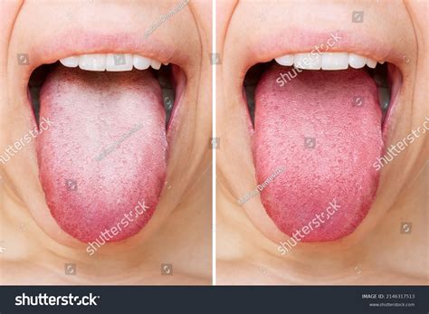 What Does A Healthy Tongue Look Like What Does A Healthy Tongue Look Like