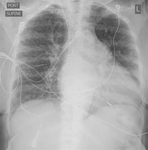 Faces Of Emphysema The Common Vein