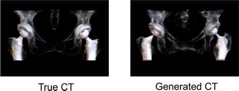 Measurement Of The Acetabular Cup Orientation After Total Hip Arthroplasty Based On 3