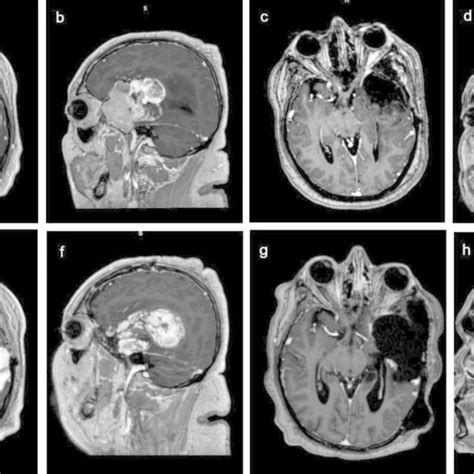 Radiological Features A Voluminous Tumour In The Left Temporal Pole