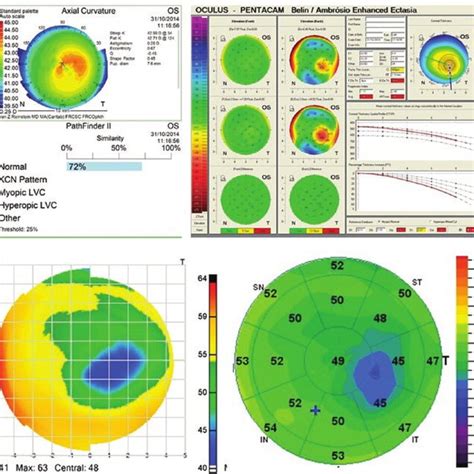 Corneal Epithelial Maps Arcscan Insight 100 And Optovue Rtvue On The