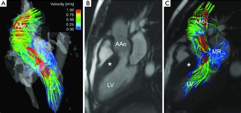 4d Flow Mri In A Patient With Obstructive Hypertrophic Cardiomyopathy