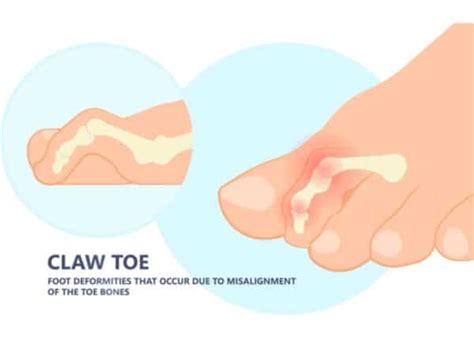 Claw Toes Toe Deformities Pain In Toes Vail Frisco Denver Co