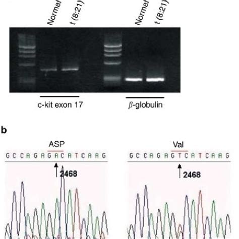 Detection Of C Kit Mutation In Exon 17 In A T 8 21 Aml With Trisomy 4 Download Scientific