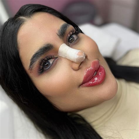 ‎تزريق ژلفیلربوتاکسگارداسیلفيلربادینخفيشالکرجاندیشهفردیس