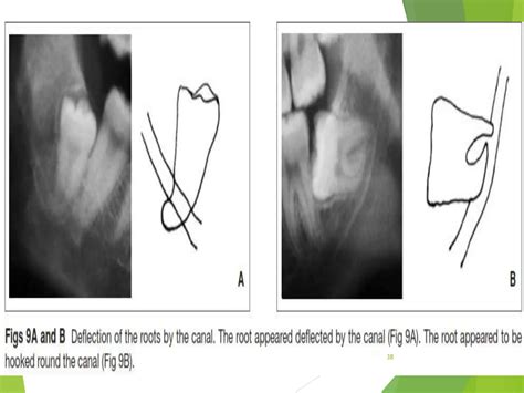 Third Molar Impacted Tooth Development And Surgical Complicationspptx