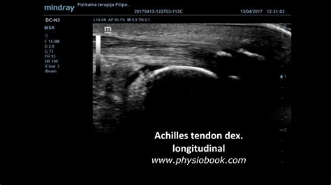 Achilles Calcification Tendinitis Calcificans Haglund Syndrome Msk
