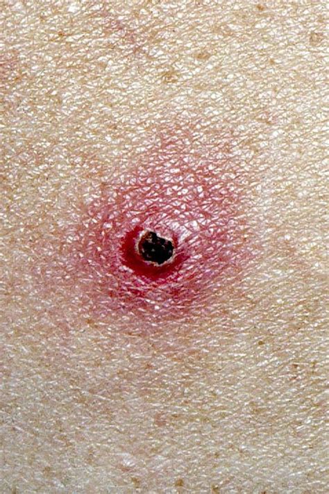 Cat Scratch Disease Infectious Diseases Msd Manual Professional Edition