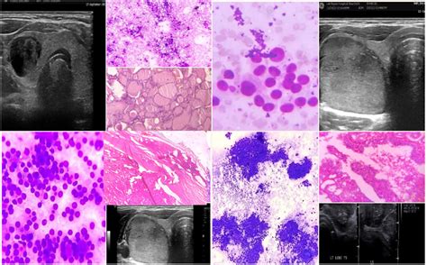 Correlation Of Ultrasound‐based Tirads And The Bethesda System For Reporting Of Thyroid