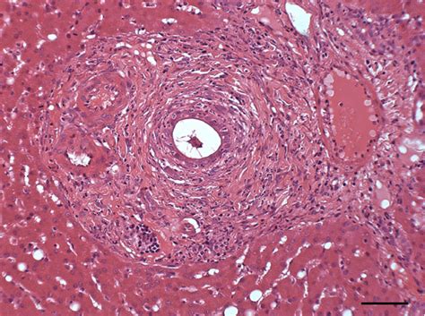 Bacterial Cholangitis Semantic Scholar