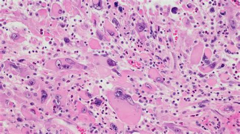 Combining Targeted Therapy And Immunotherapy Improves Overall Survival