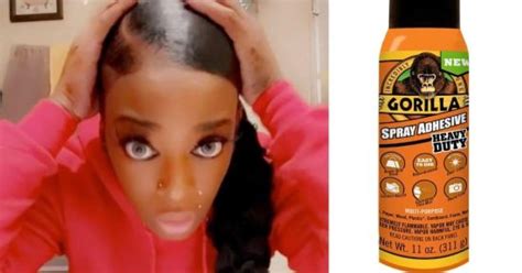 내가 어리석었다헤어스프레이 대신 강력 접착제 사용한 美 여성 수술 후 회복 중