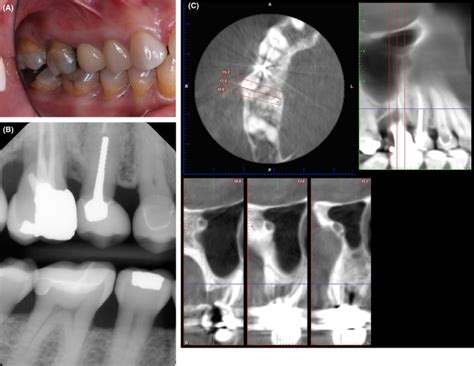 Maxillary Root Amputation Case Report With A 14‐year‐follow‐up And