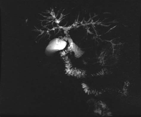 Primary Sclerosing Cholangitis Causes Symptoms Prognosis Treatment