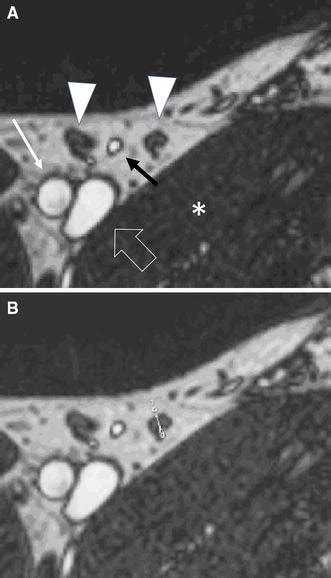 Deep Inguinal Lymph Node Without A And With Maximal Short Axis