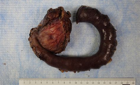 Pathology Outlines Gist