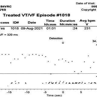 Plot Diagram Demonstrates Typical Oversensing Pattern Inappropriate VF Download Scientific