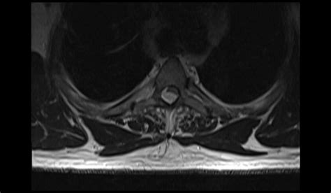 Spinal Epidural Hematoma Mri Radiology Article On Spinal Epidural