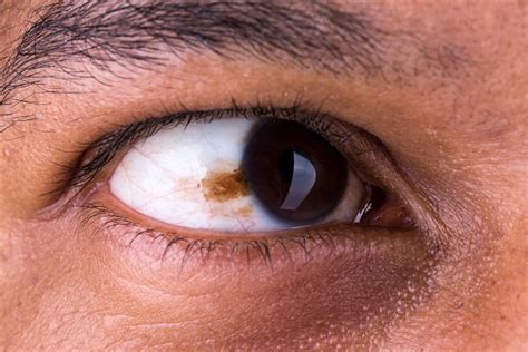 Eye Cancer Ocular Cancer Causes Symptoms Treatment Diseasefix