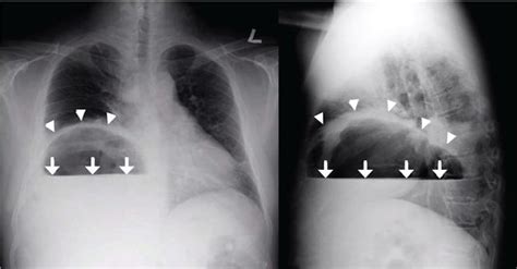 ‘air Raising An Air Fluid Level In The Right Subphrenic Region