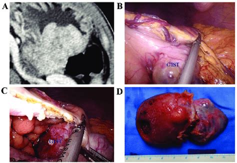 Laparoscopic Resection For Gist Located In The Posterior Wall Of The
