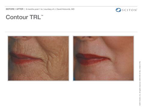 Contour Trl In Florence Ky Erbium Yag Laser Treatment