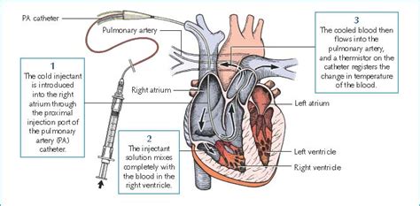 cardiac output measurement nurse key