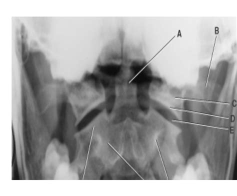 Open Mouth Odontoid Diagram Quizlet