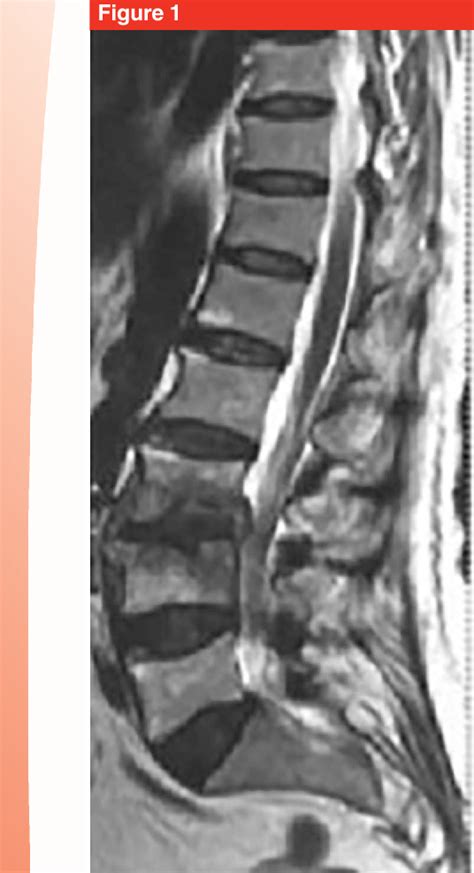 Figure 1 From Granulomatous Vertebral Osteomyelitis An Update Semantic Scholar