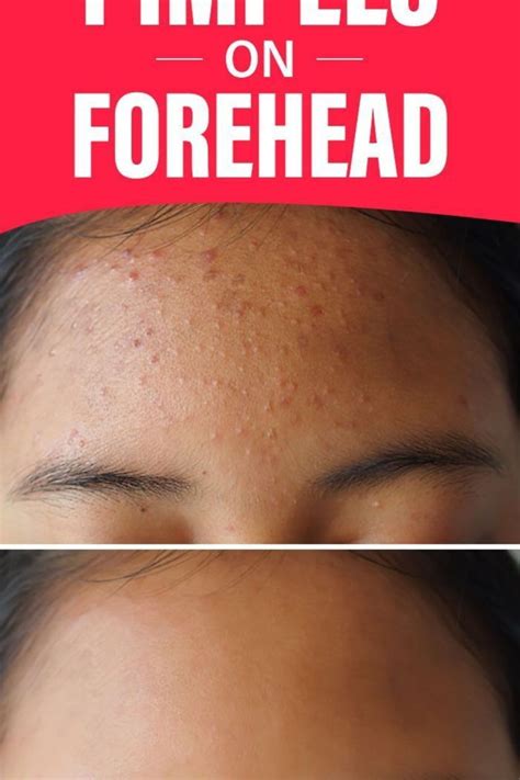 How To Remove Pimples Artofit