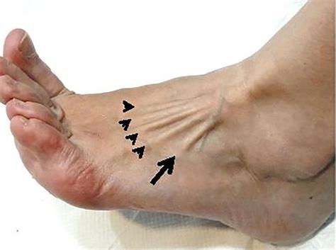 Peroneus Tertius Tendon