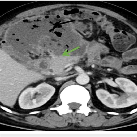 Contrast Enhanced Computed Tomography Cect Abdomen Showing Normal Download Scientific Diagram
