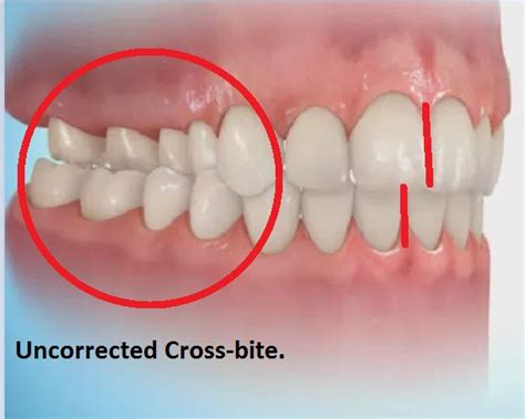 Crossbite Braces