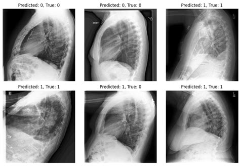 Mv Mff Multi View Multi Feature Fusion Model For Pneumonia Classification