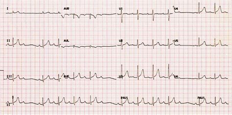Second Degree Av Block Mobitz Ii Ecg
