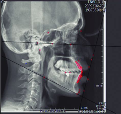 semi automated cephalometric tracing using facad software download