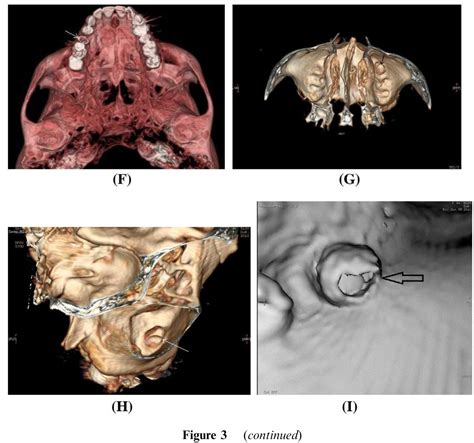 Figure 5 Periapical Abscess Of The Maxillary Teeth And Its