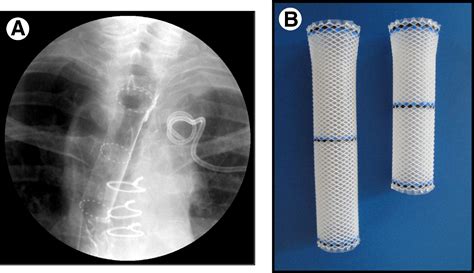 Esophageal Stents Past Present And Future Techniques In