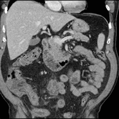 Computed Tomography Showing Terminal Ileitis Download Scientific Diagram