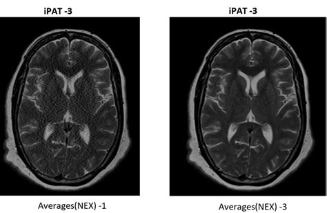 Parallel Imaging Artifact Mri Parallel Imaging Artifact
