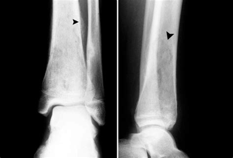 Osteomyelitis Detection And Treatment